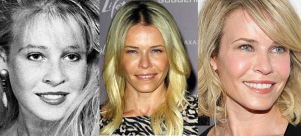 Chelsea Handler Plastic Surgery Before and After Pictures 2025