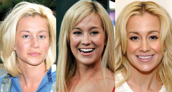 Kellie Pickler Plastic Surgery Before and After Pictures 2025