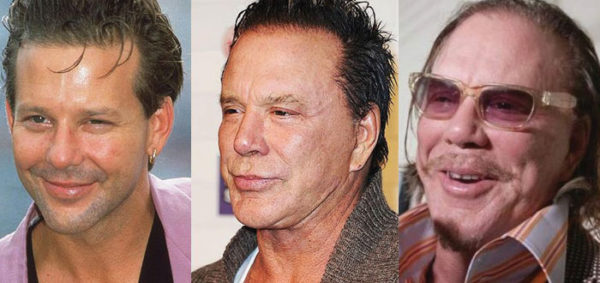 Mickey Rourke Plastic Surgery Before and After Pictures 2025