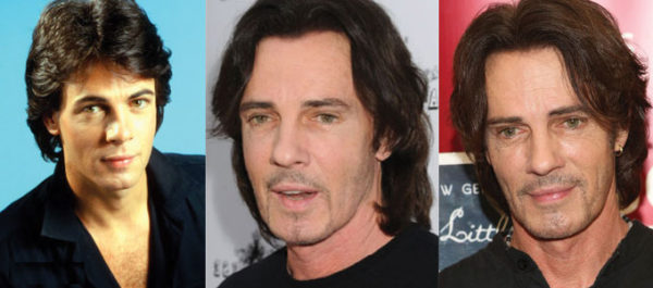 Rick Springfield Plastic Surgery Before and After Pictures 2025